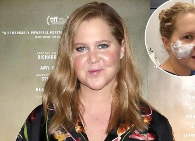 Amy Schumer's Plastic Surgery: Examining Liposuction and Fillers
