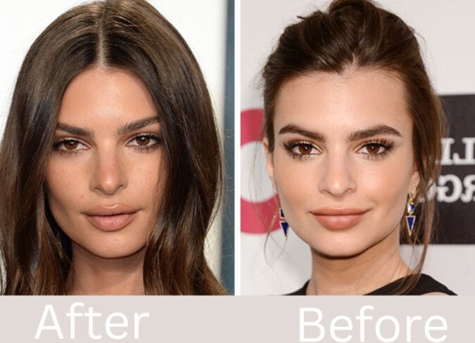 Emily Ratajkowski's Plastic Surgery: Her Changed Look Will Shock You