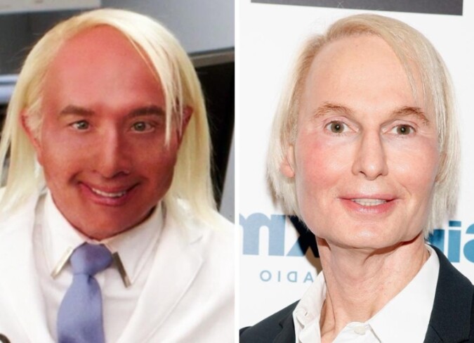 Martin Short Plastic Surgery: Has Martin Had A Nose Job/Cheek Lift?